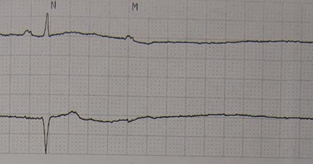 Muşchiul inimii, reparat cu ajutorul celulelor suşă cardiace | Poza 1